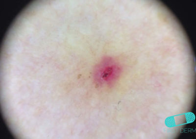 Guía de la piel - Úlcera