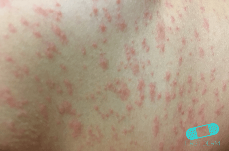 Heat Rash (Prickly Heat): Symptoms, Causes & How to Treat It