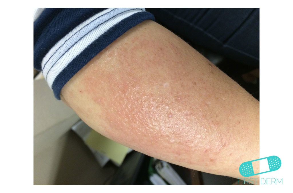 Neurodermatitis National Eczema Association AMGH News