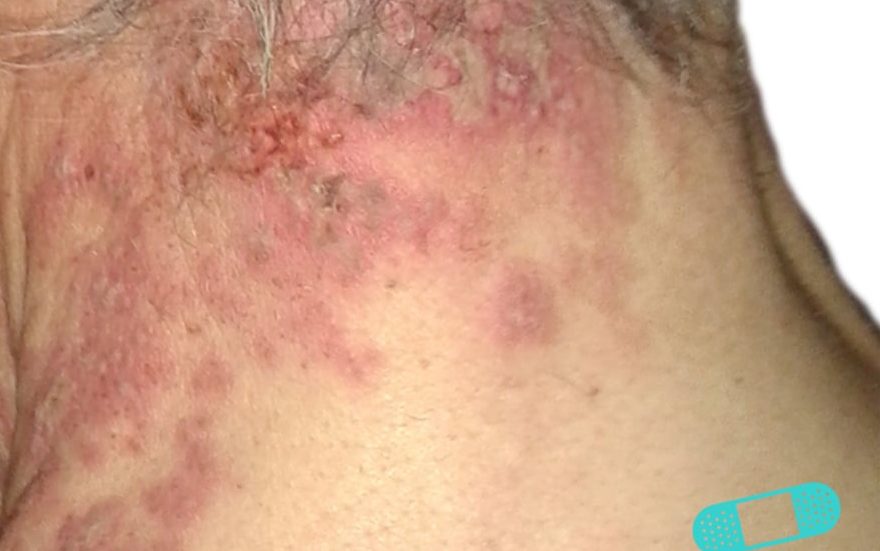 Herpes Zoster (Shingles) - Online Dermatology