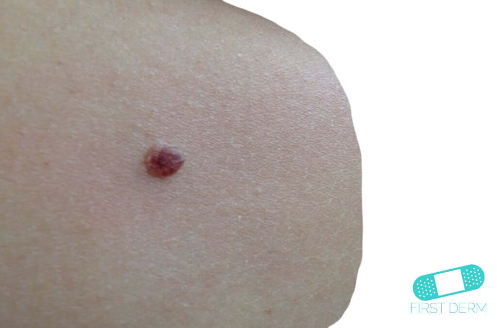 Online Dermatology - Intradermal nevus