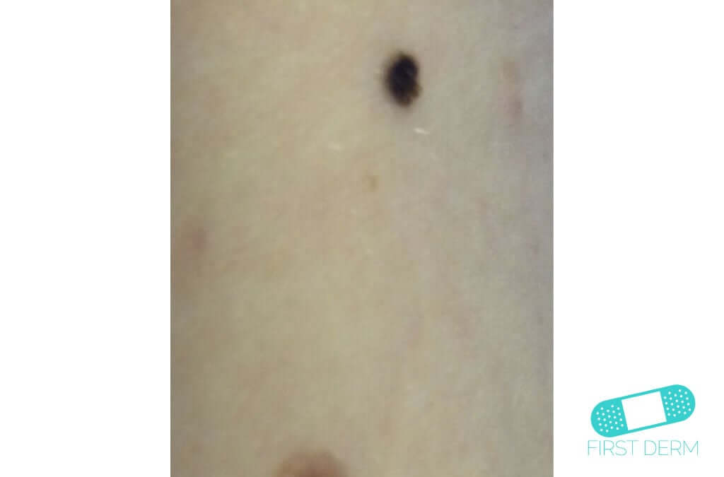 Online Dermatology - Intradermal nevus