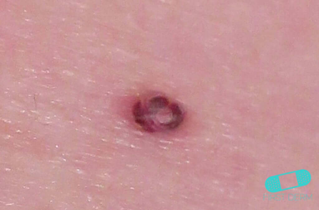 Online Dermatology - Angioma