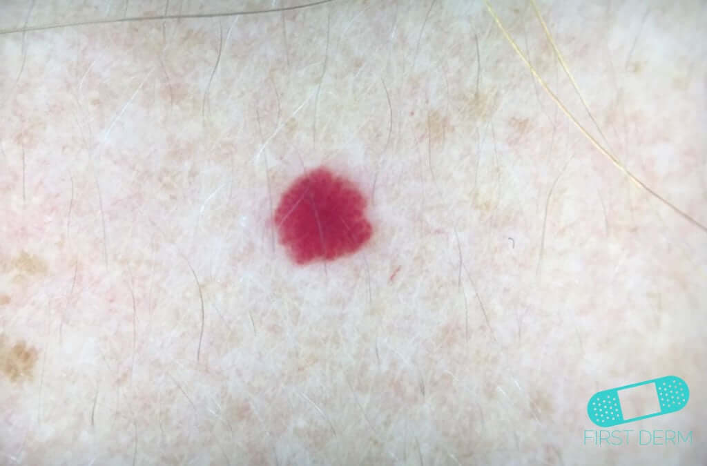 Online Dermatology Angioma online-dermatology-angioma
