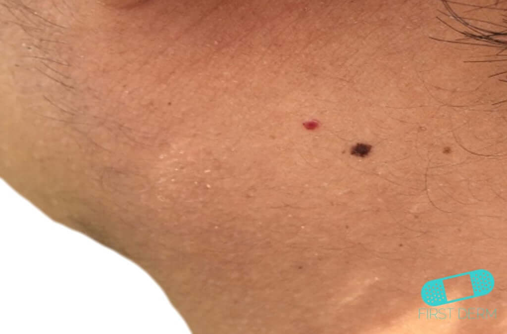 Online Dermatology - Angioma