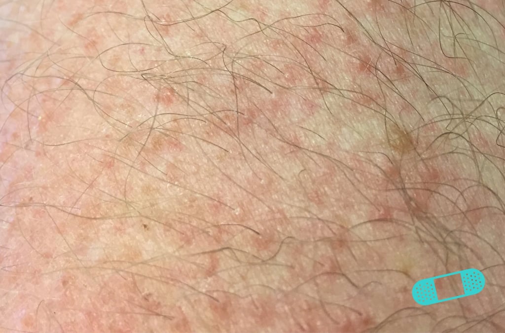 Online Dermatology - Contact Dermatitis