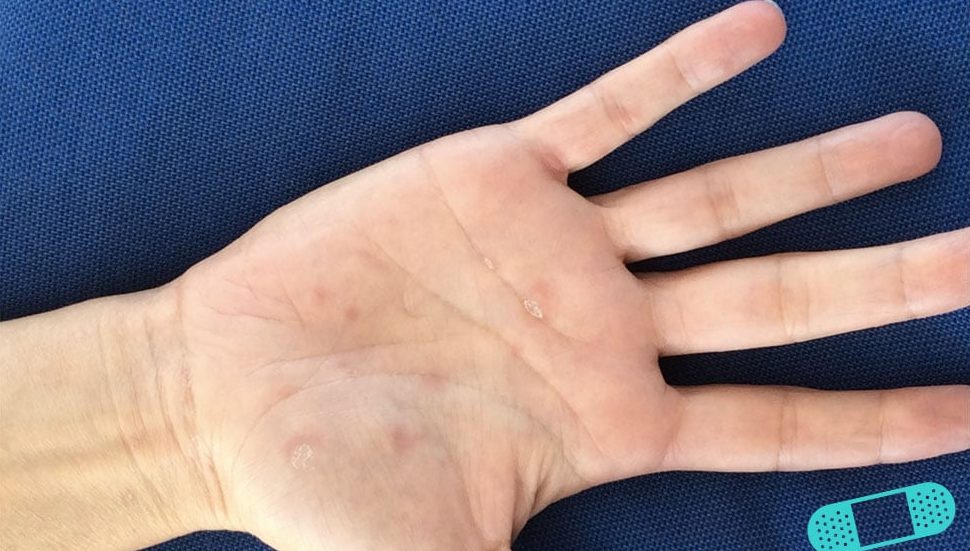 Dyshidrotic eczema (dyshidrosis) - Online Dermatology