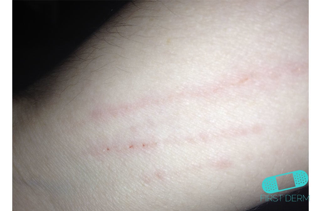 Urticaria Dermatografica