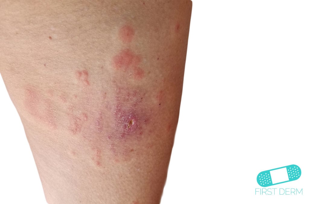 Erythema Multiforme - Online Dermatology