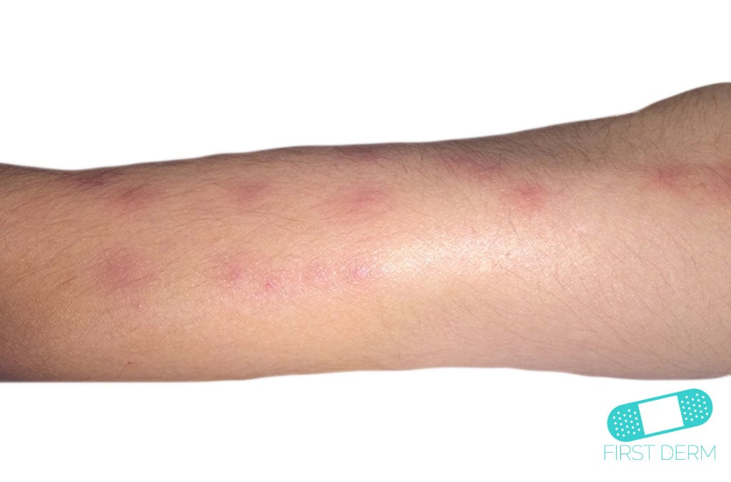 Guía de la piel - Ronchas (urticaria)