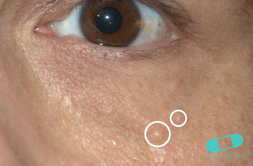 Online Dermatology - Syringoma