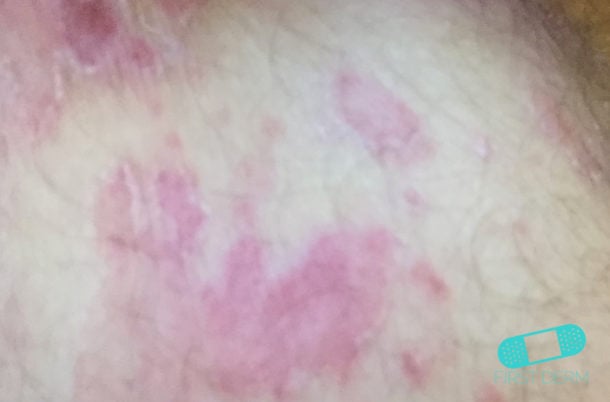 Itchy Rash Pictures: 15 most common cases and their treatment