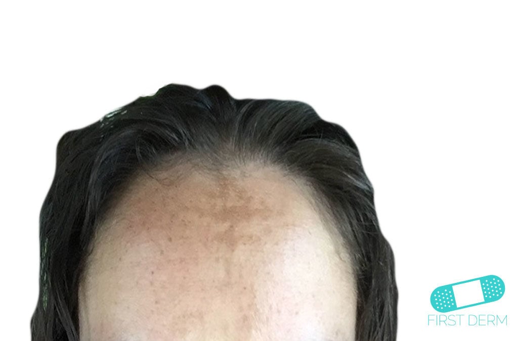 Hyperpigmentation : Causes, Types and Treatments