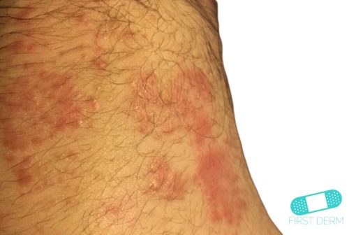 Itchy Red Bumps on Skin – Potential Causes and Treatment