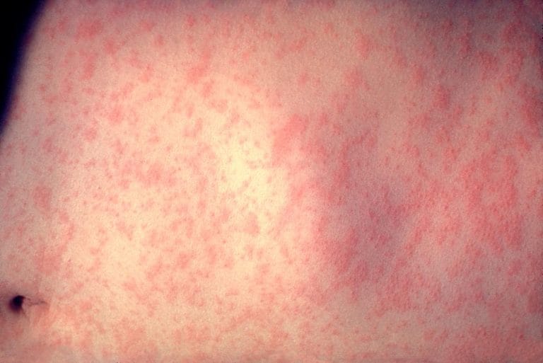 Spots and Rashes Caused by Viruses - Online Dermatology