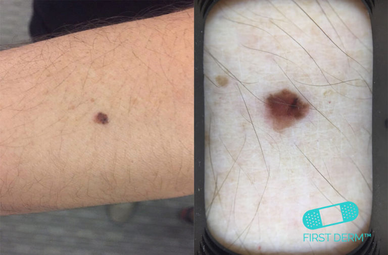 How Our First Derm App Can Save Your Life
