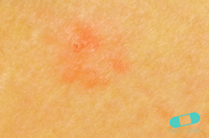 Vacation Gone Wrong: 7 Skin Rashes People Got Abroad - Travel