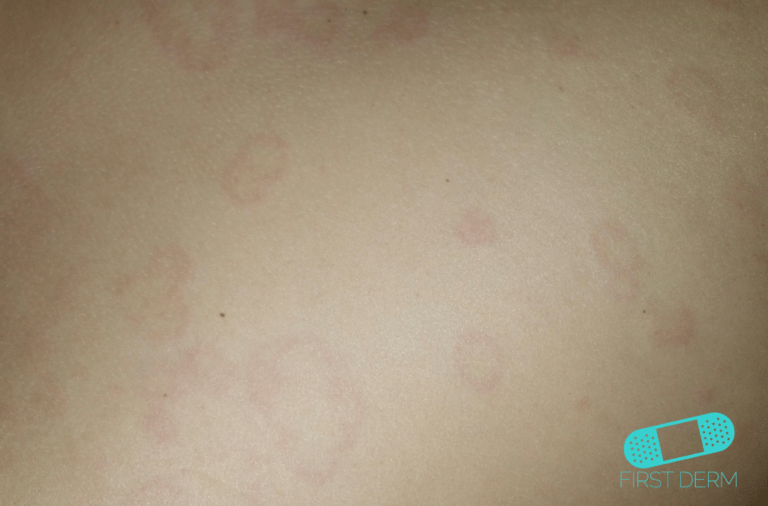 Vacation Gone Wrong: 7 Skin Rashes People Got Abroad - Travel