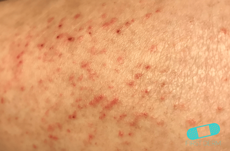 Vacation Gone Wrong: 7 Skin Rashes People Got Abroad - Travel