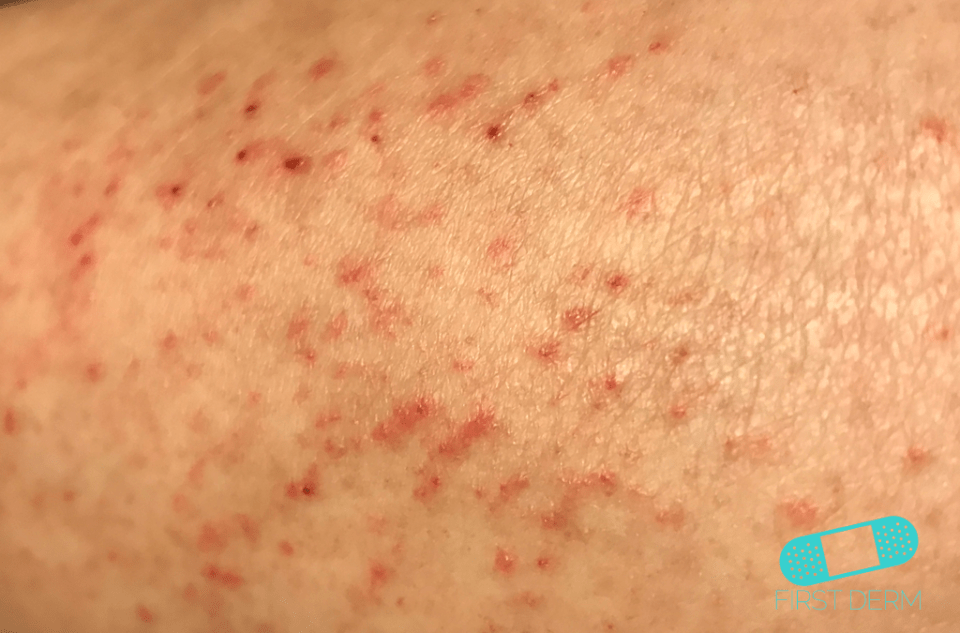 Vacation Gone Wrong: 7 Skin Rashes People Got Abroad - Travel