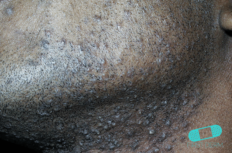 10 Most Common Black Skin Conditions and their treatment - First Derm