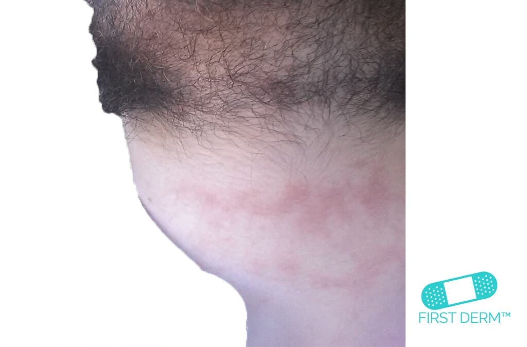 Itchy rash, red and spots on your skin, what could they be? - First Derm