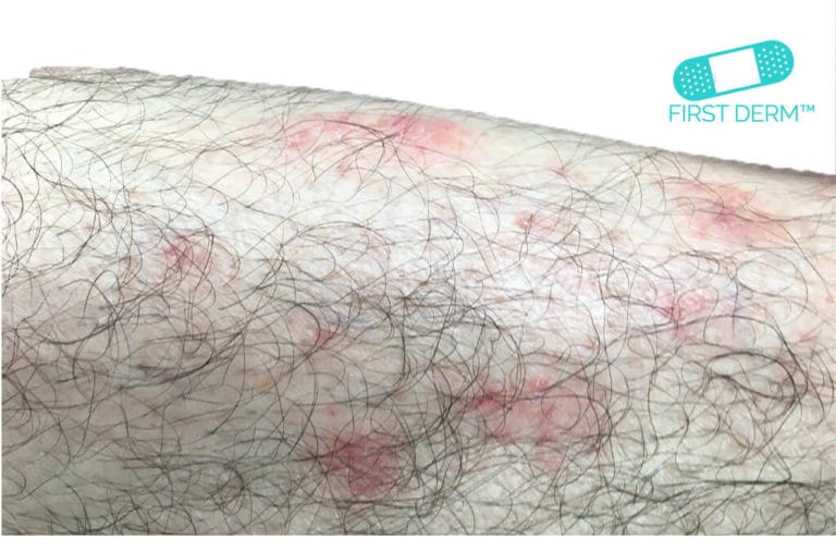 Itchy Rash Pictures: 6 most common cases and their treatment