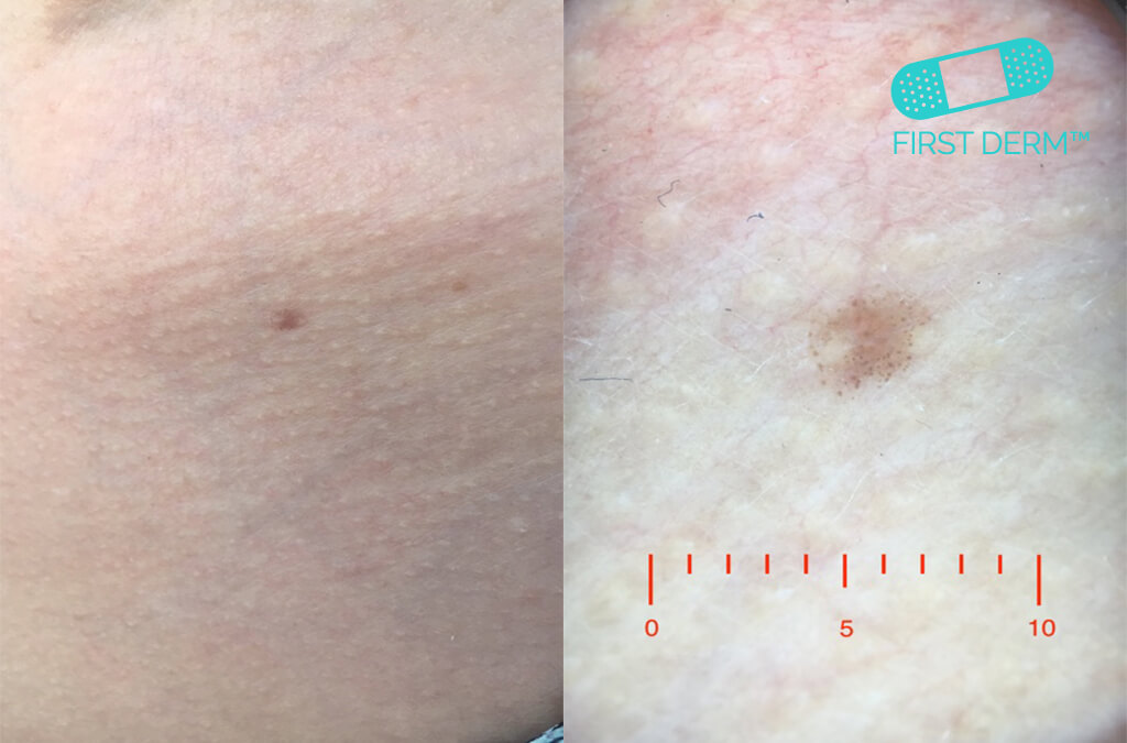 Dermoscopy - screen for skin cancer quickly before a biopsy available ...