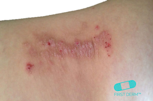 Itchy Rash Pictures: 15 most common cases and their treatment