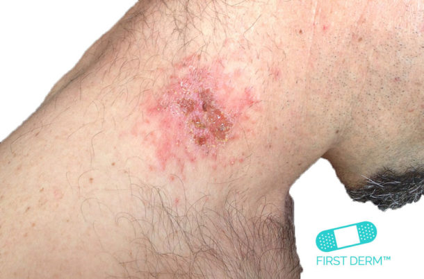 Itchy Rash Pictures: 6 most common cases and their treatment