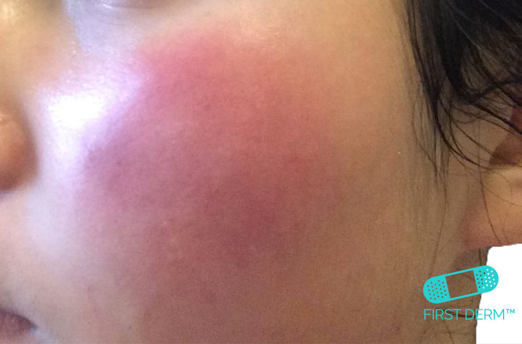 Retinol (Tretinoin): det du behöver veta – Frågor & Svar till hudläkaren