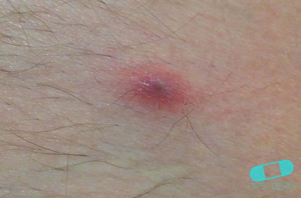 Guía de la piel - Absceso