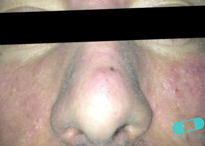 Acné Vulgar (Granos) Guía de la piel