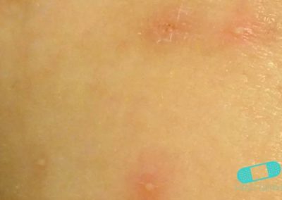 Acne Vulgaris (Zits)