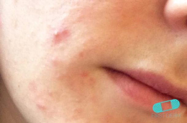 Itchy Red Bumps on Skin – Potential Causes and Treatment