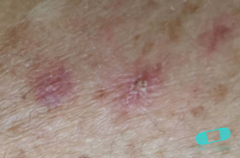 Actinic Keratosis (AK) - Online Dermatology