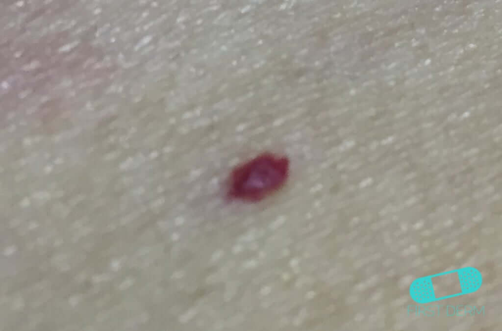 Angiom - Hudläkare på nätet - First Derm