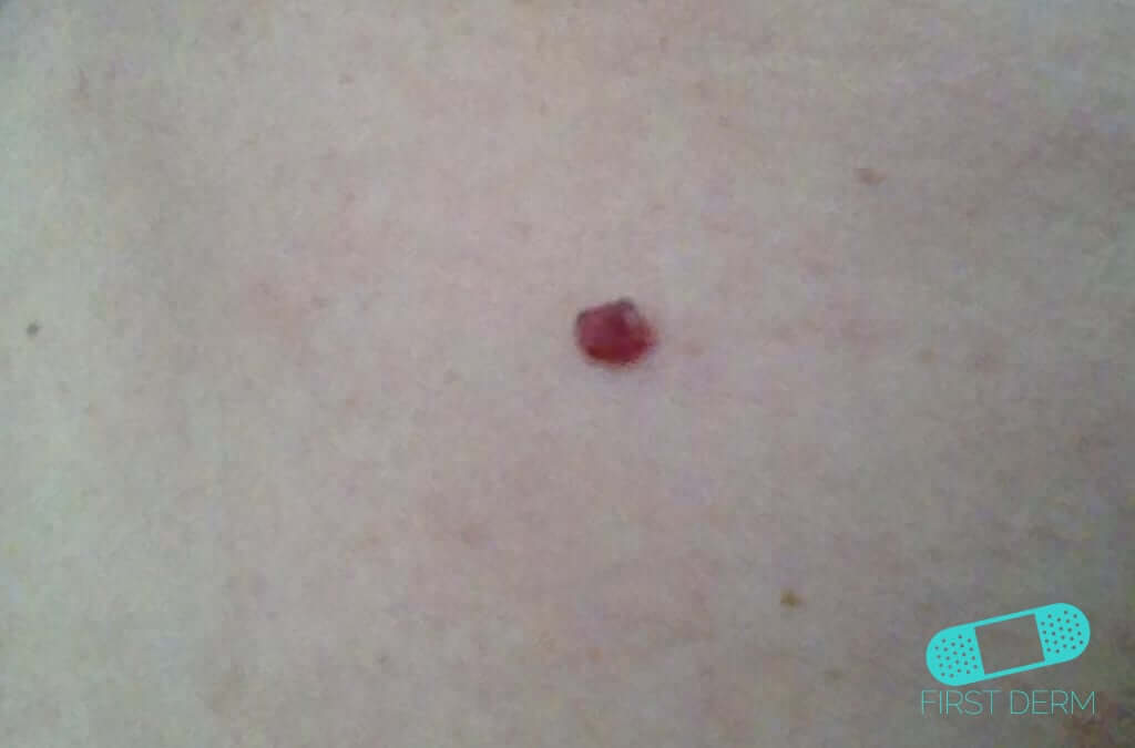 Angioma - Online Dermatology