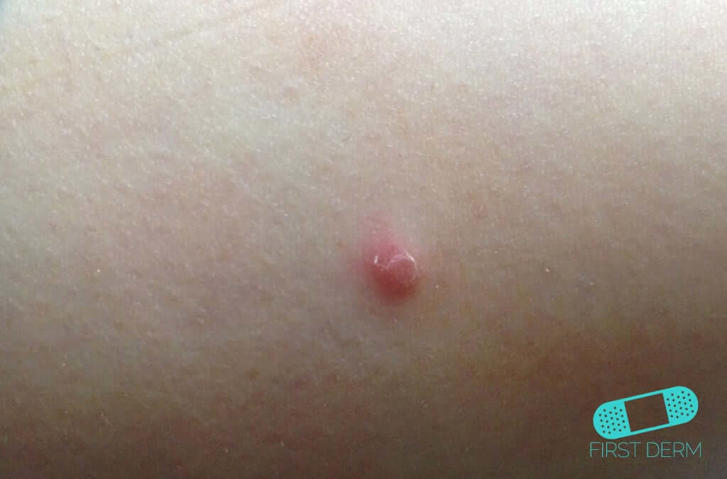 Pierna De Cáncer De Piel De Células Basales