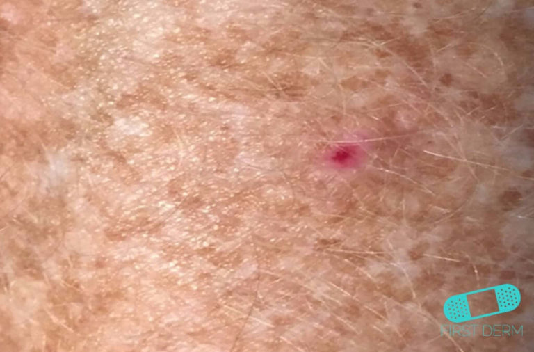 Basal cell carcinoma (Basalioma, BCC) - Online Dermatology