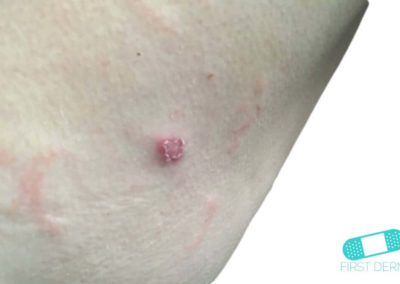 Hudläkare på nätet – Basalcellscancer (basaliom)