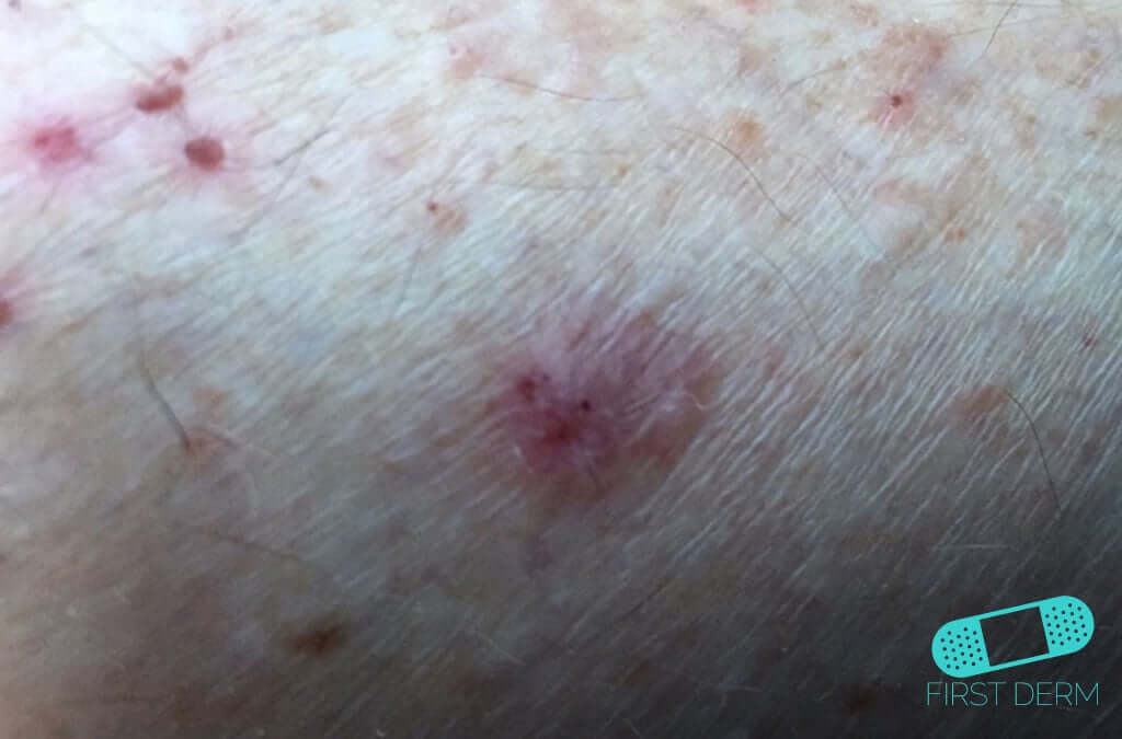 Hudläkare på nätet – Basalcellscancer (basaliom)