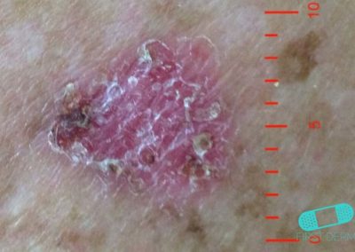 Hudläkare på nätet – Basalcellscancer (basaliom)