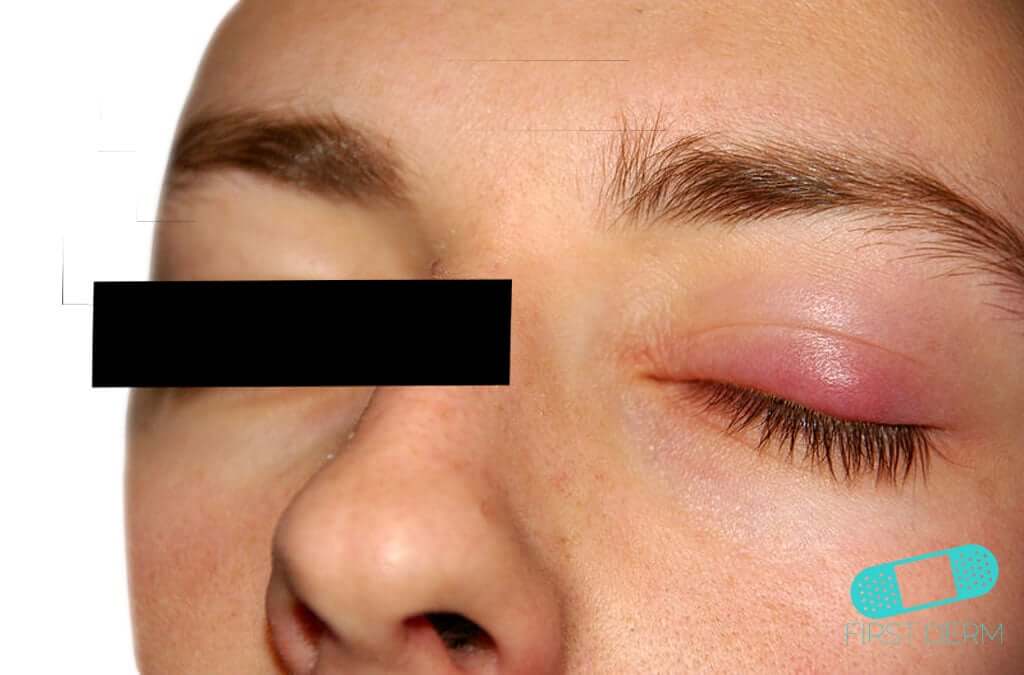 Online Dermatology - Chondrodermatitis Nodularis Helicis