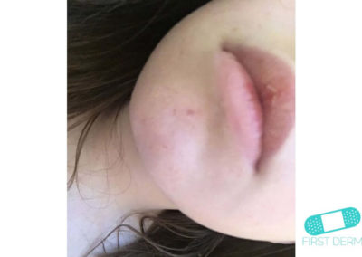 Online Dermatology - Comedones