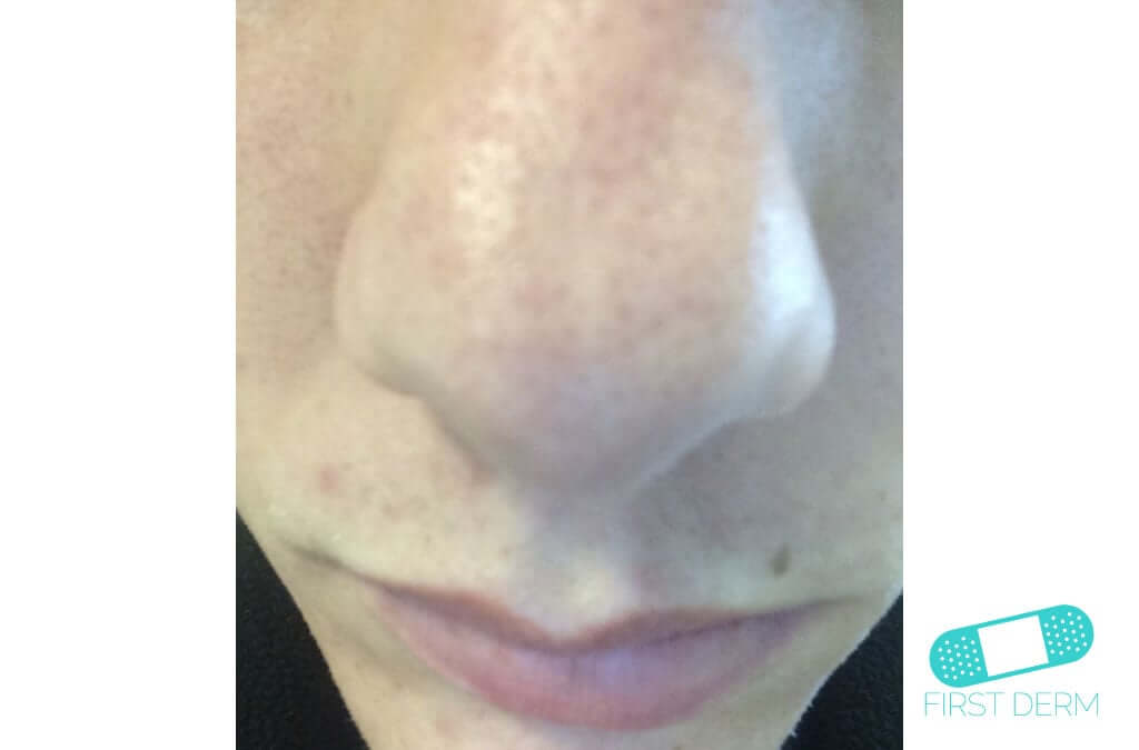 Comedones - Guía de la piel