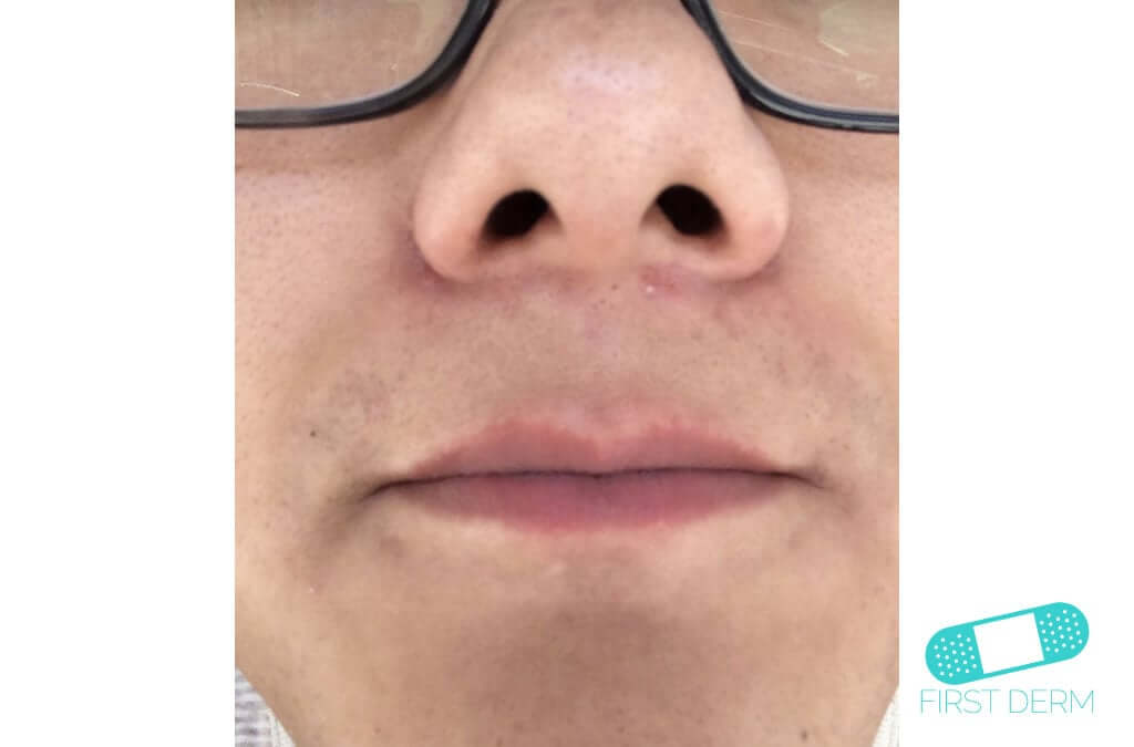 Online Dermatology - Costra Láctea (Dermatitis Seborreica)