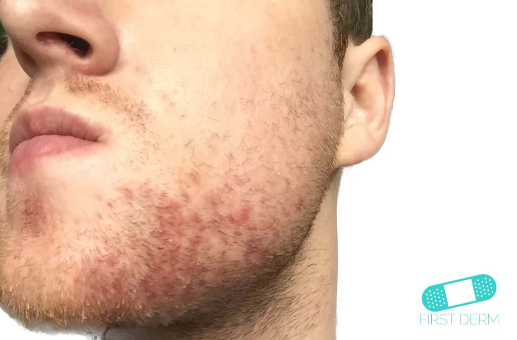 Guía de la piel - Dermatitis Seborreica (Eccema Caspa)