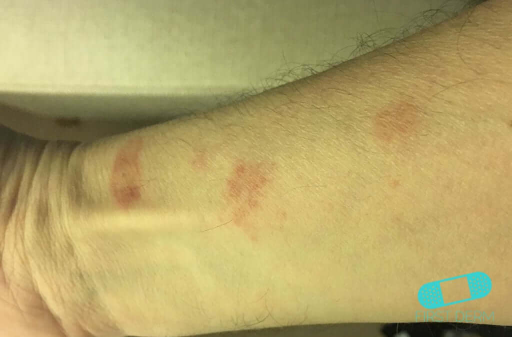 Eccema Numular (Dermatitis Discoide) - Guía de la piel