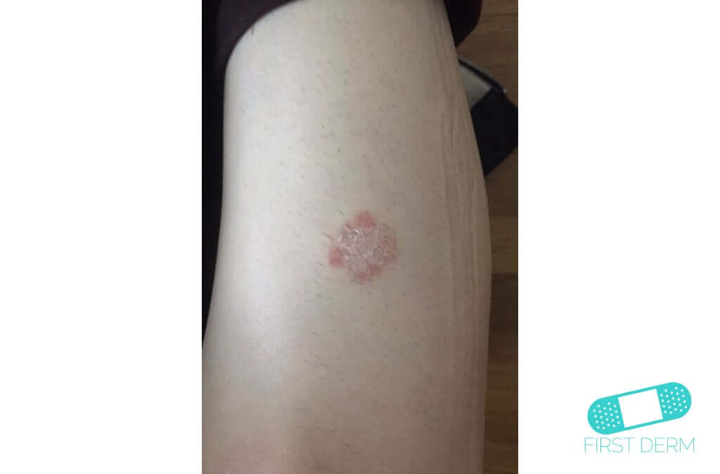 Eccema Numular (Dermatitis Discoide) - Guía de la piel